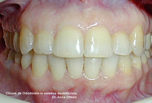 Indreptare dinti - ortodontie adulti